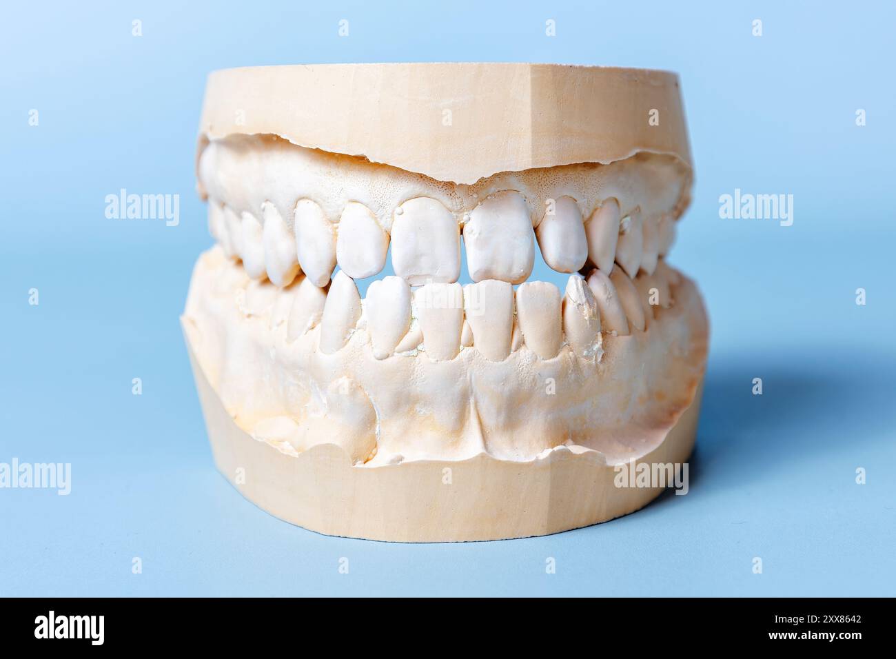 Close-up of a dental plaster model of jaw with teeth. This model is ...