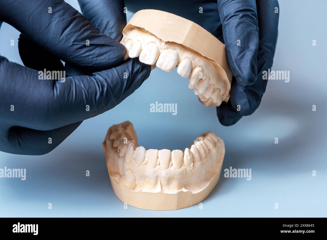 Dental plaster jaw model being held in gloved hands. The model shows ...