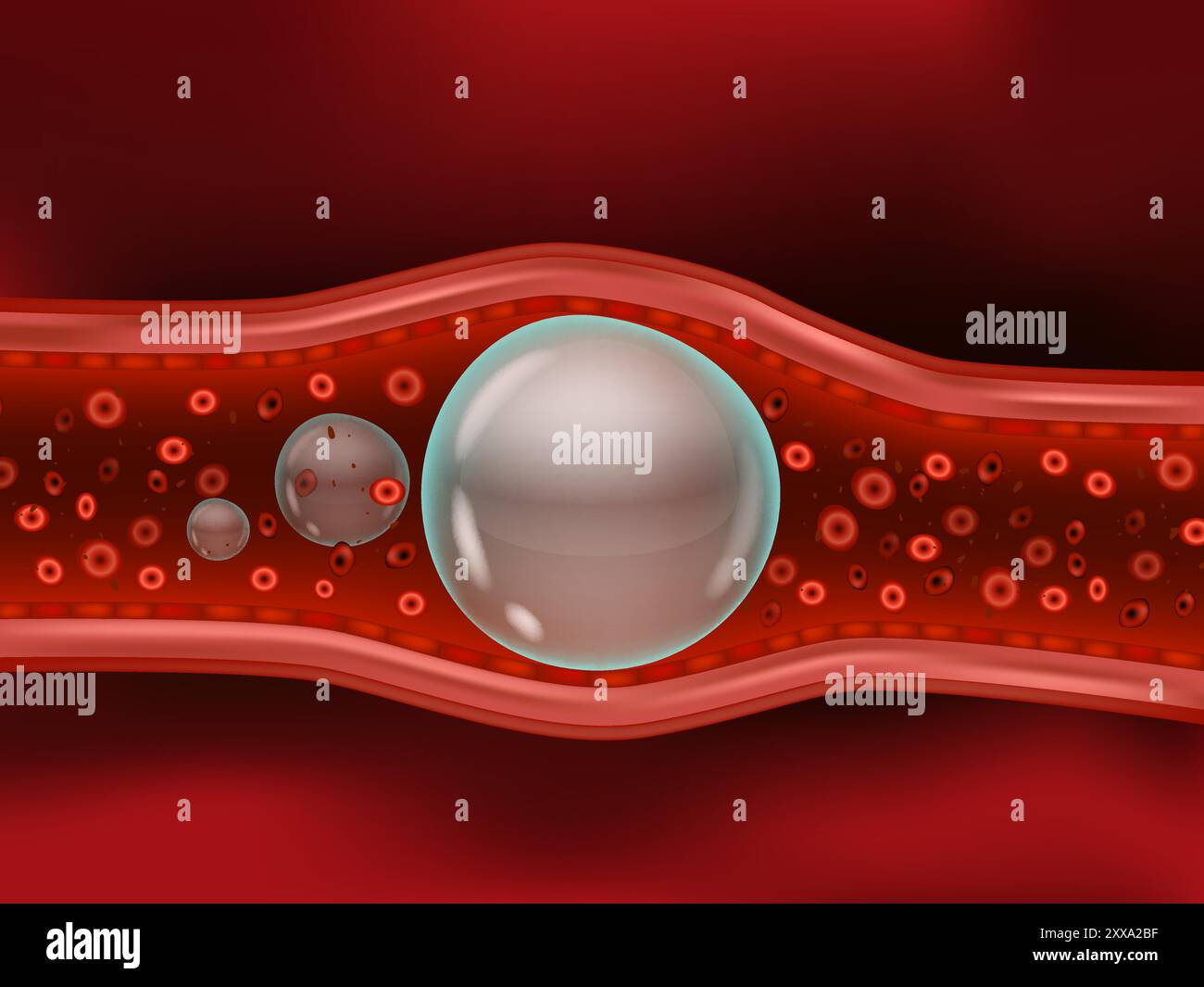 An air embolism, also called a gas embolism Stock Vector Image & Art ...