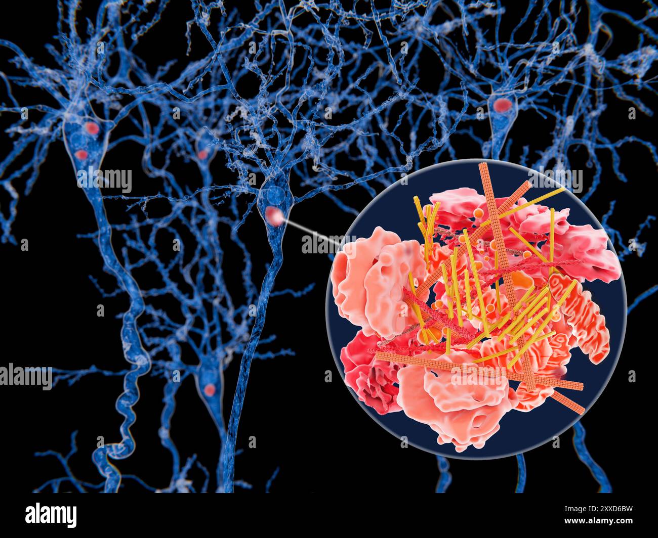 Illustration showing Lewy bodies (red) in neurons (blue) with a close ...