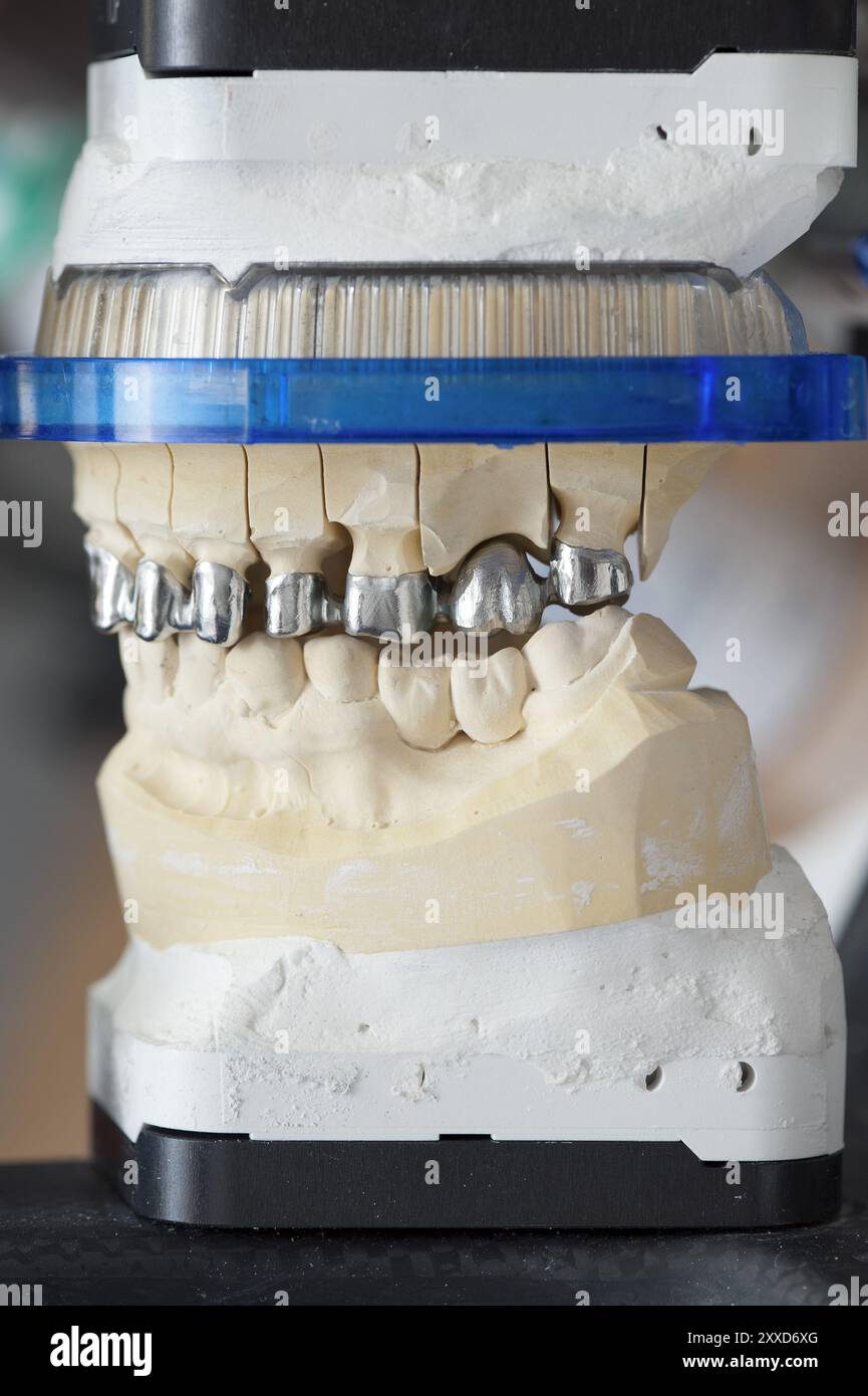Denture model with crown framework in the articulator Stock Photo - Alamy