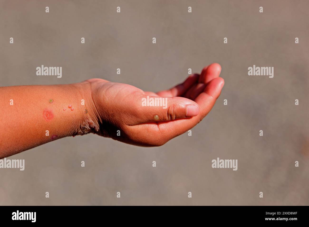 Child's hand with smallpox Stock Photo - Alamy