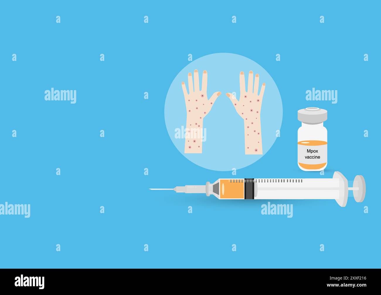 Illustration showing a syringe, Mpox vaccine vial, and infected hands ...