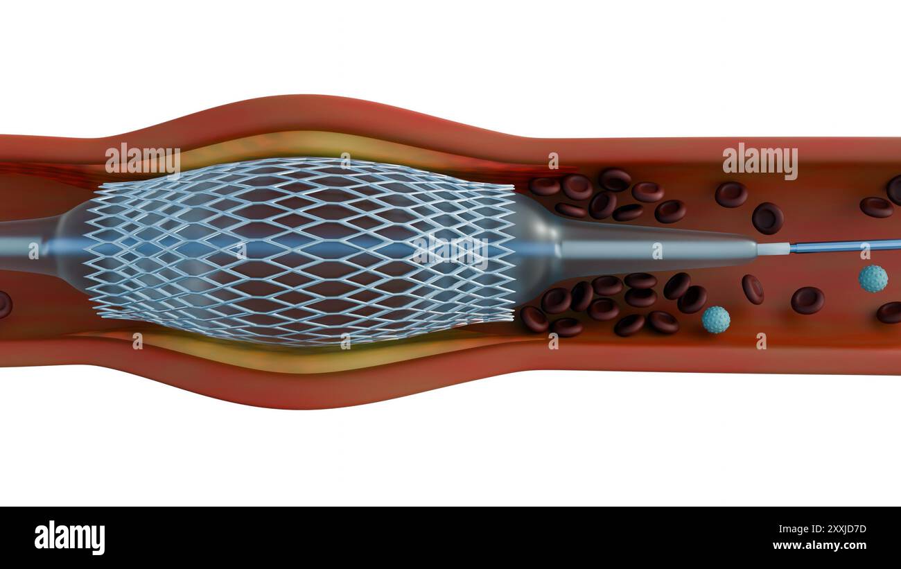 A 3D rendering of a stent inside a blood capillary can visualize the procedure. Angioplasty is a ...