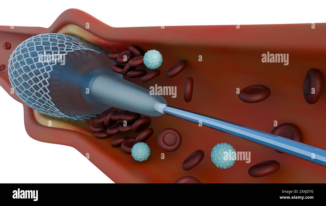 A 3D rendering of a stent inside a blood capillary can visualize the ...