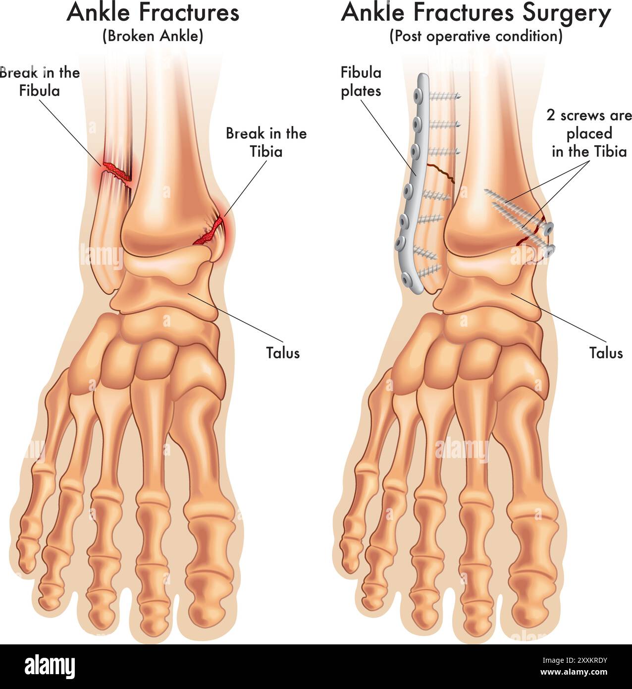 medical illustration compares a fractured ankle before and after surgery, with annotations Stock ...