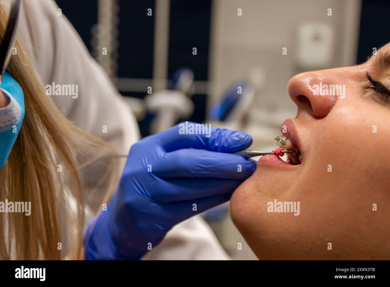 Installation process temporary tooth in self-ligating braces for a ...