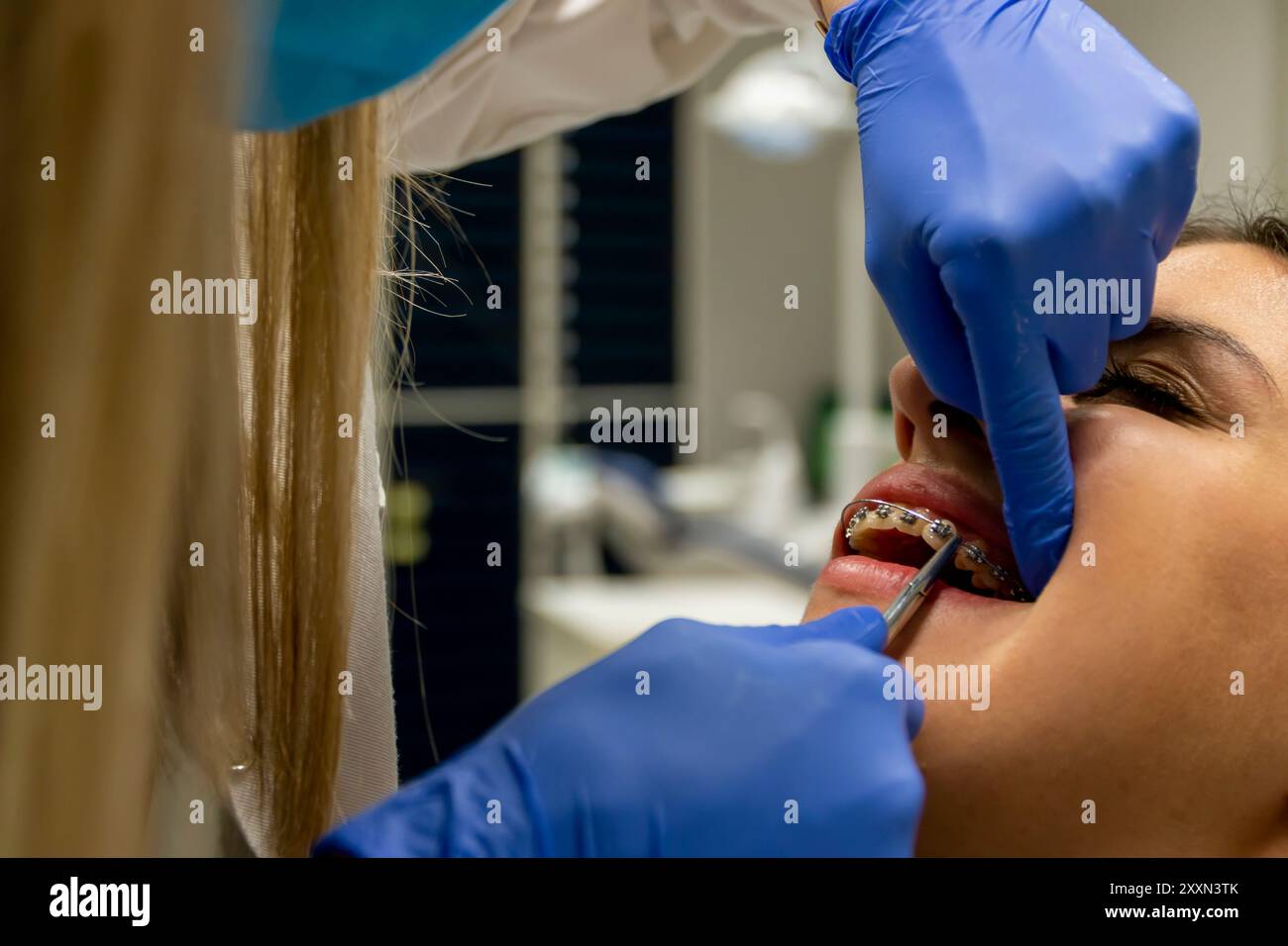 Installation process temporary tooth in self-ligating braces for a ...