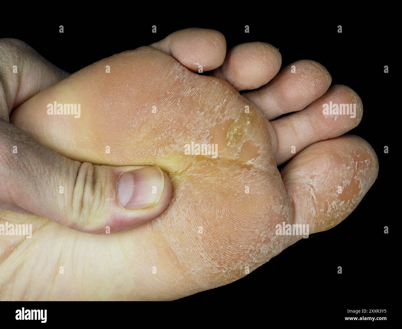 Skin peeling off from under foot, examined by podiatrist, at closeup ...