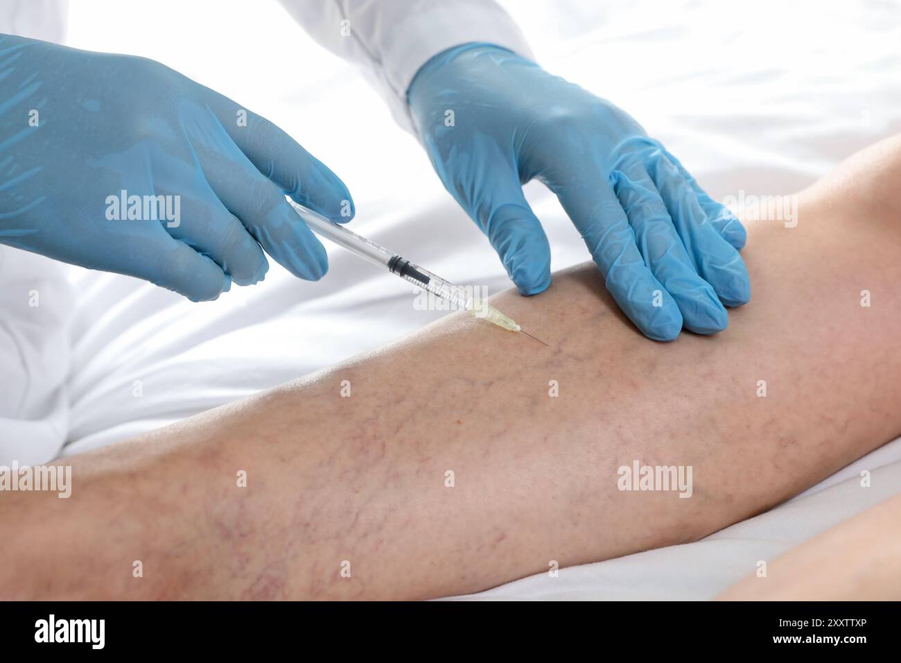 Varicose veins treatment. Doctor giving injection to patient indoors ...