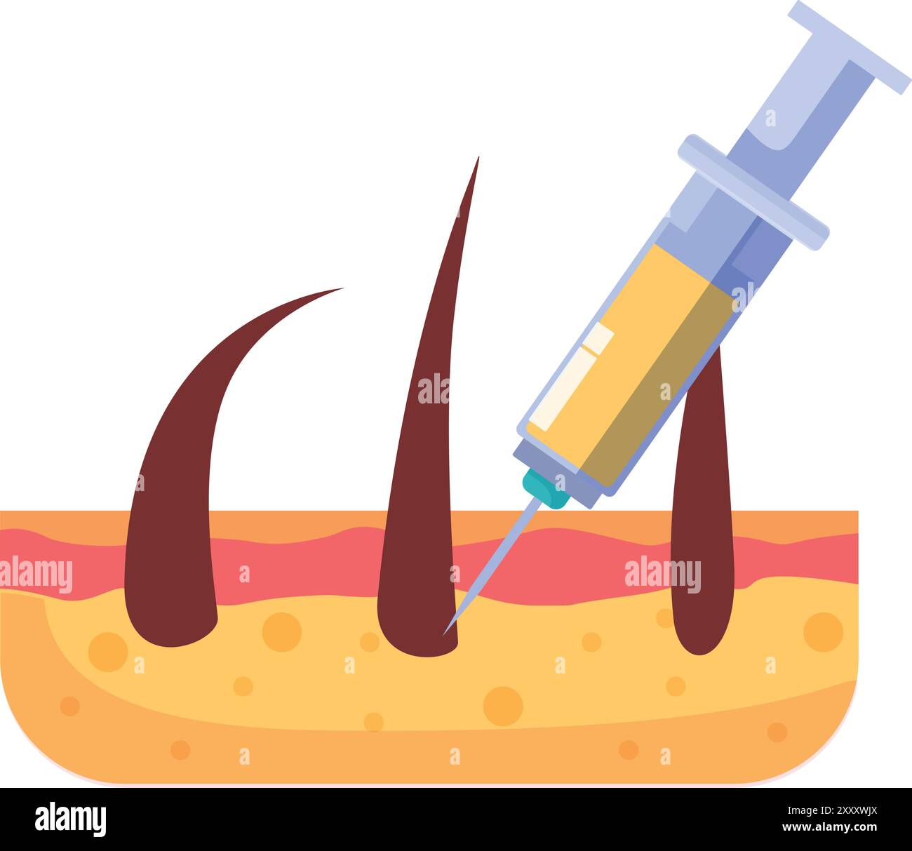 Illustration of a syringe injecting serum into skin for hair growth ...
