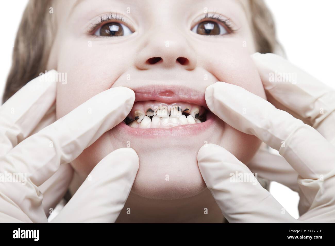 Dental medicine and healthcare, human patient open mouth showing caries ...
