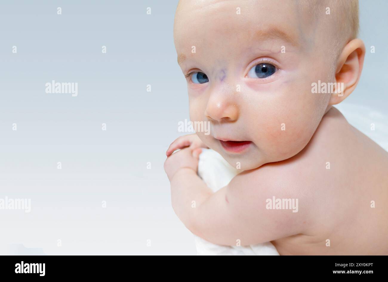 a baby with a hemangioma on his neck lies on a white background Stock ...