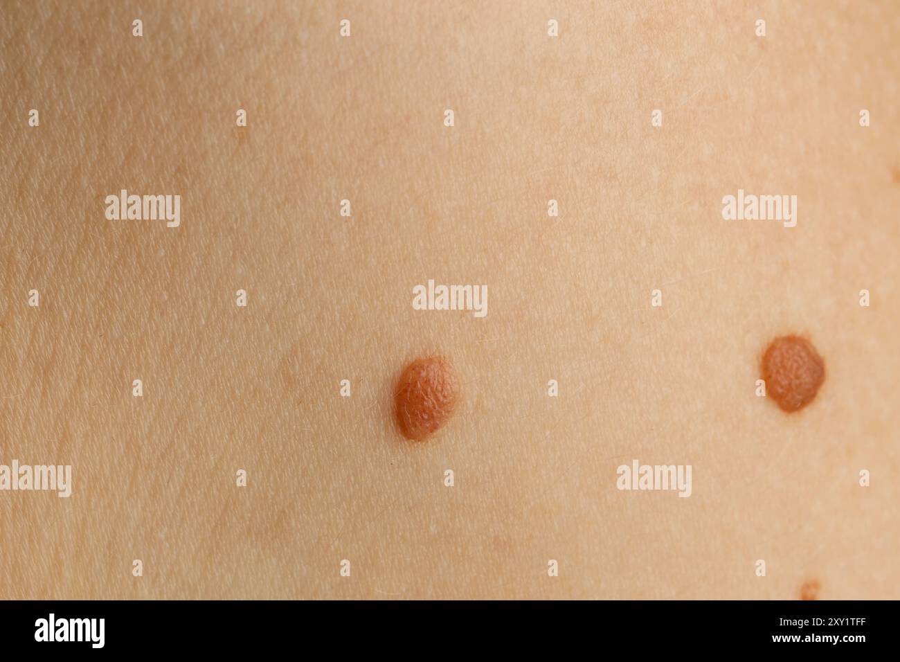 Woman with moles on her skin, closeup Stock Photo - Alamy