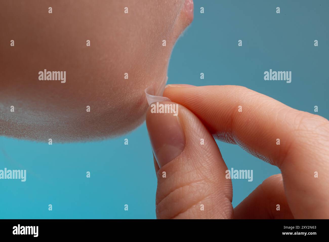 Girl with acne stick round acne patch on her cheek. Using acne patches ...