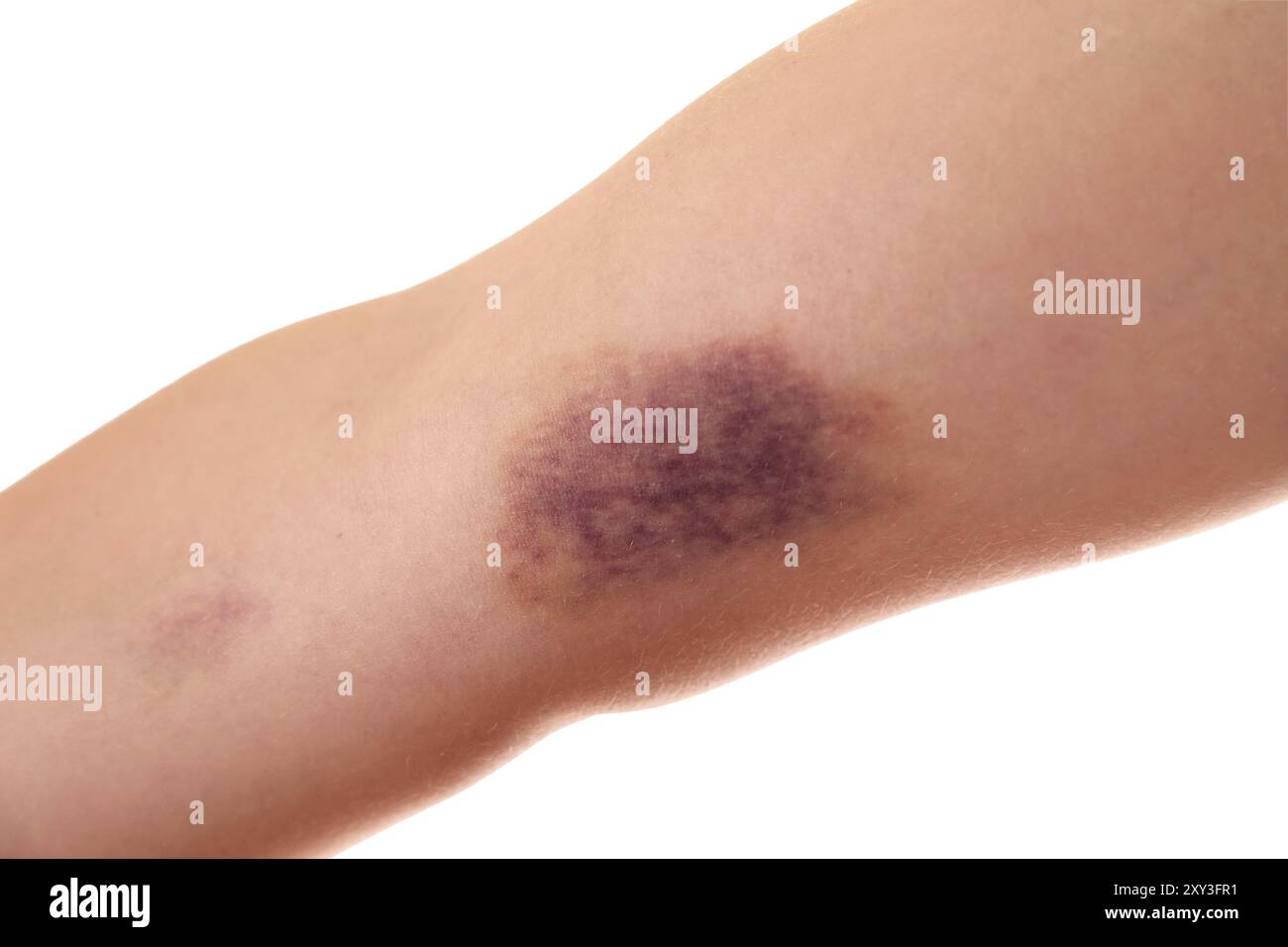 Woman with bruise on arm against white background, closeup Stock Photo ...