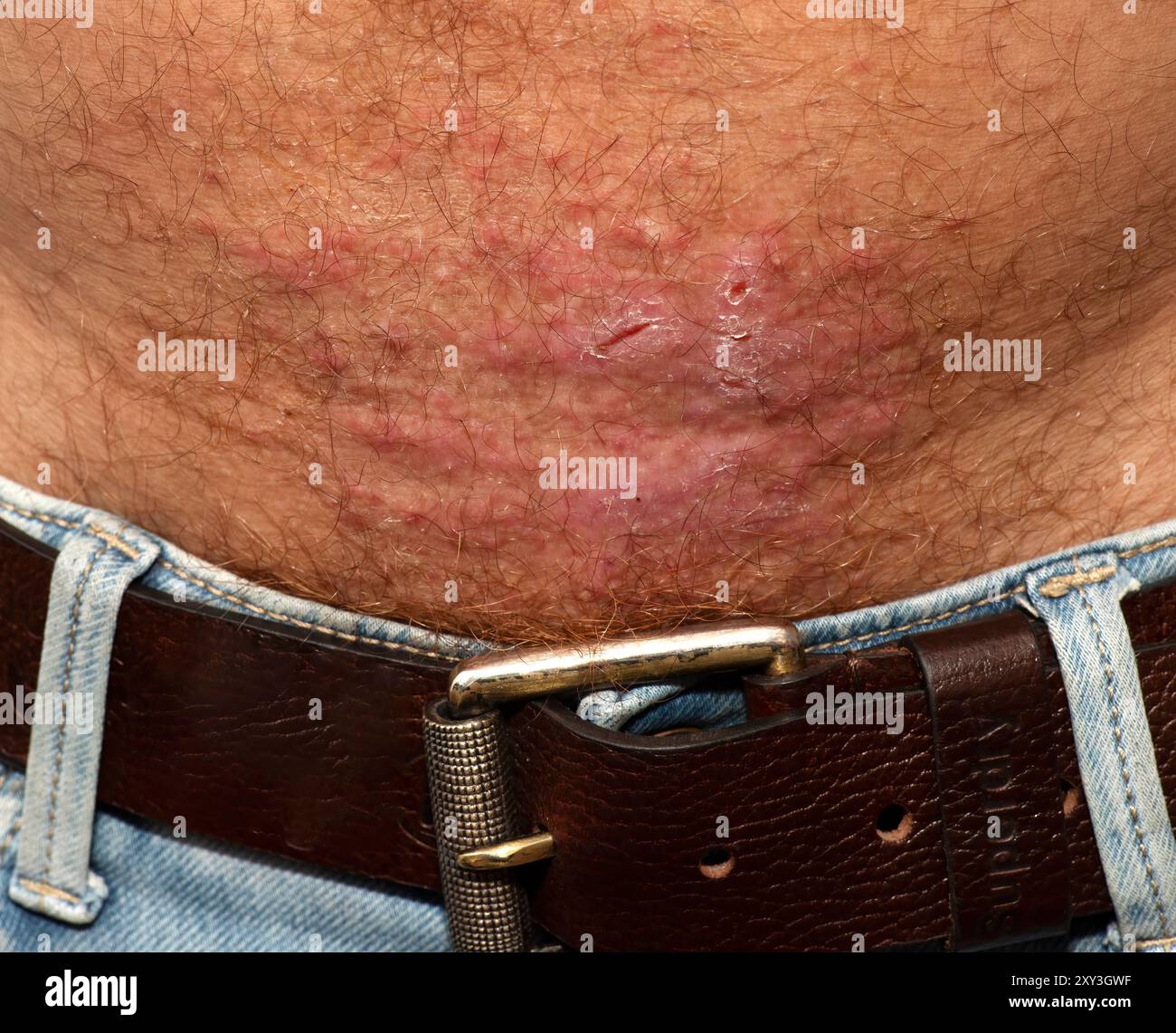 Not for use in Television Contact dermatitis from a belt buckle. Red ...