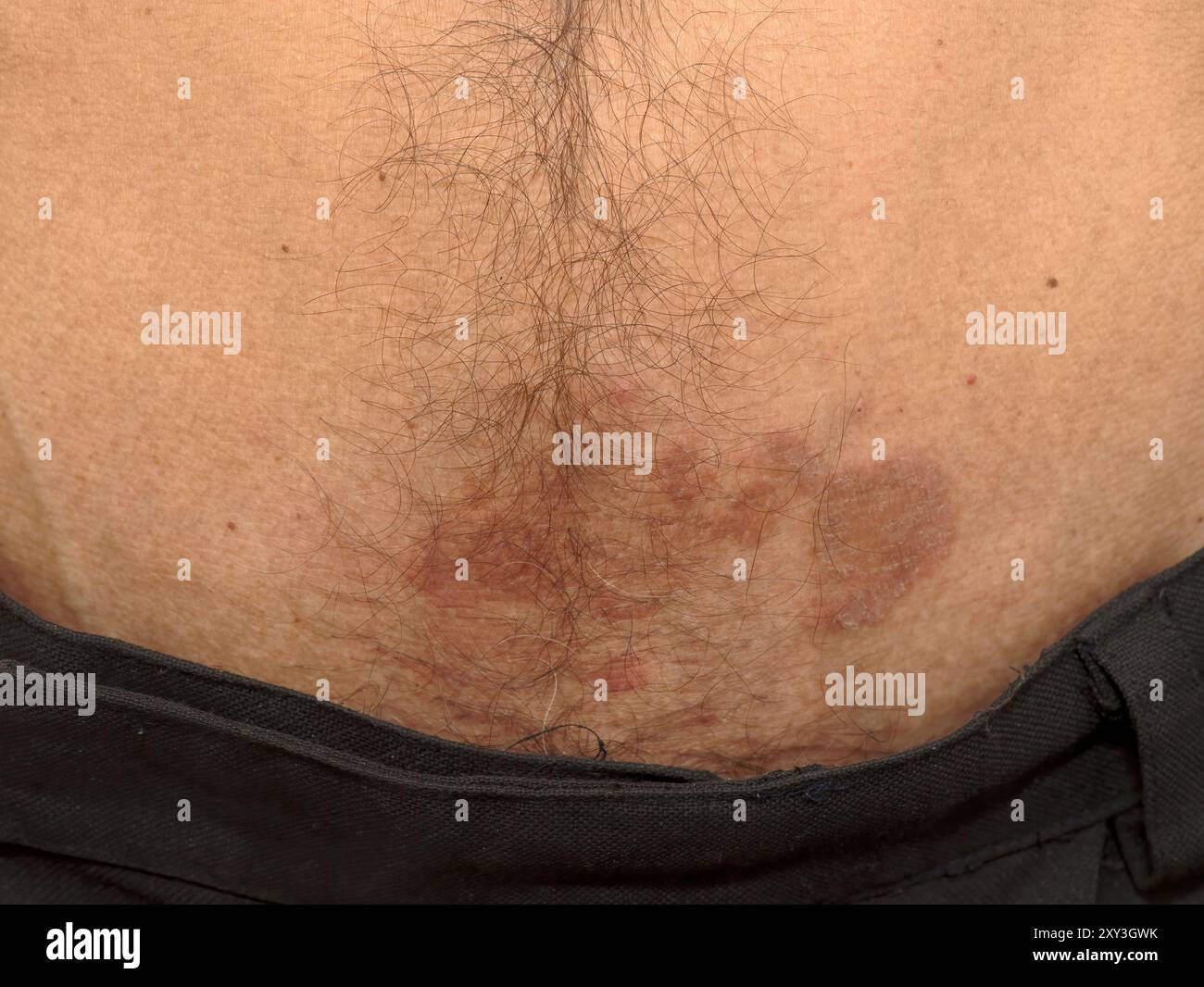 Ringworm infection on a male patient's abdomen. Ringworm is a disease ...