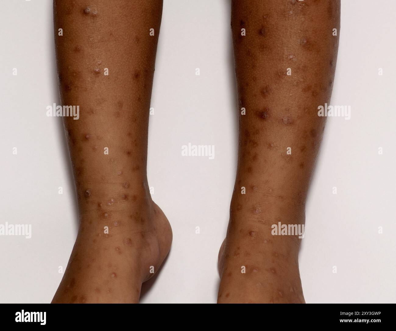 Not for use in Television Nodular scabies lesions on a girl's legs ...