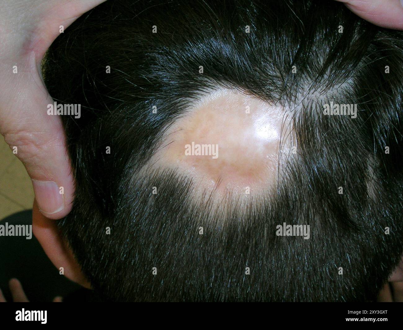 Bald patch on the scalp of a 4 year old Hispanic male patient due to ...