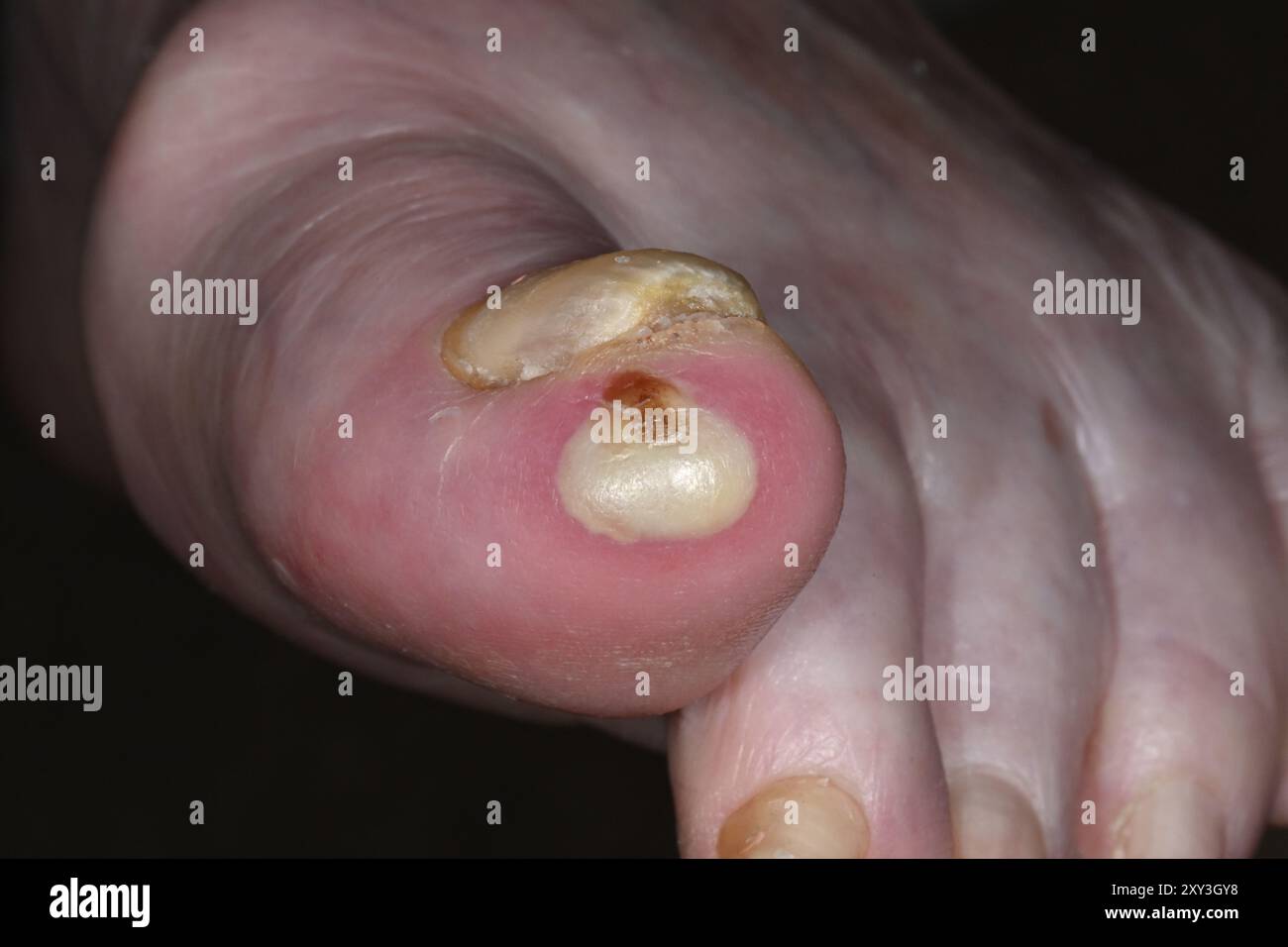 Infected big toe in a 91 year old female patient. The infection in the ...