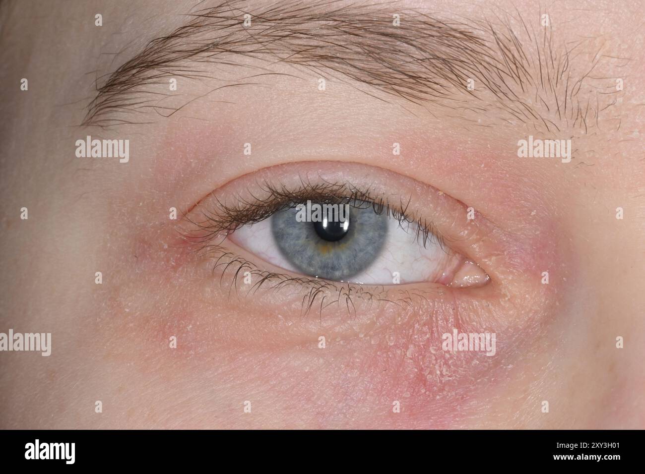 Eyelid eczema in a 16 year old female patient, also known as known as ...