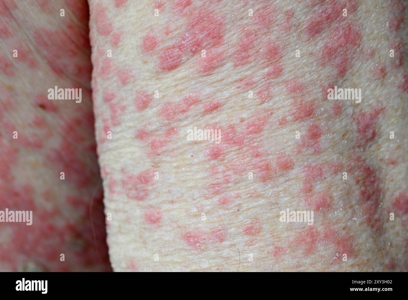 Urticaria on the skin of a 70 year old male patient Stock Photo - Alamy