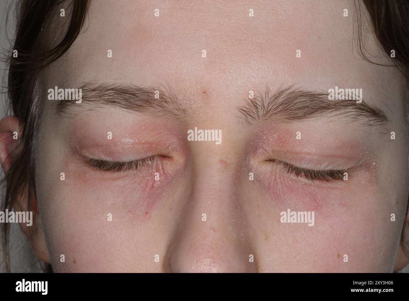 Eyelid eczema in a 16 year old female patient, also known as known as ...