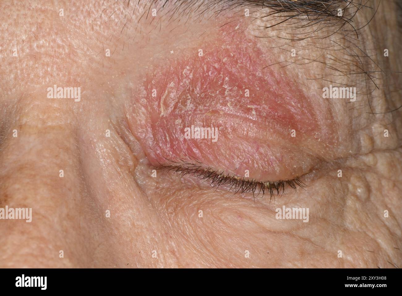 Eyelid eczema in a 77 year old male patient, also known as known as ...