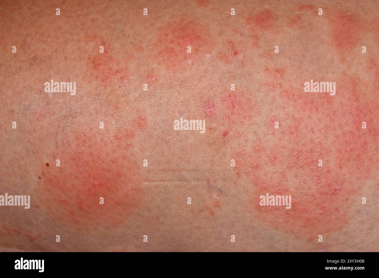 Urticaria on the leg of a 50 year old female patient Stock Photo - Alamy