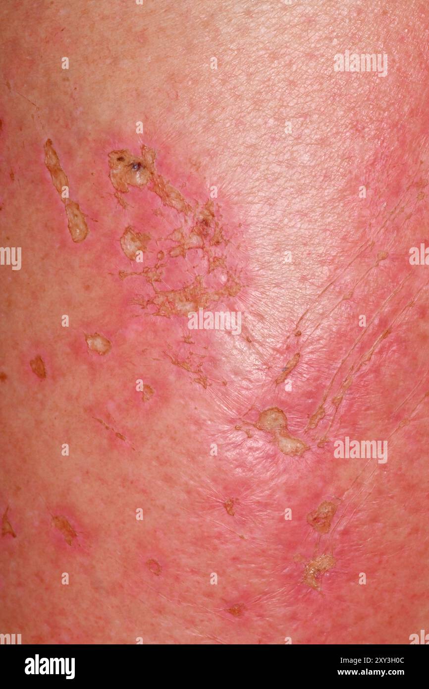 Urticaria on the leg of a 50 year old female patient Stock Photo - Alamy