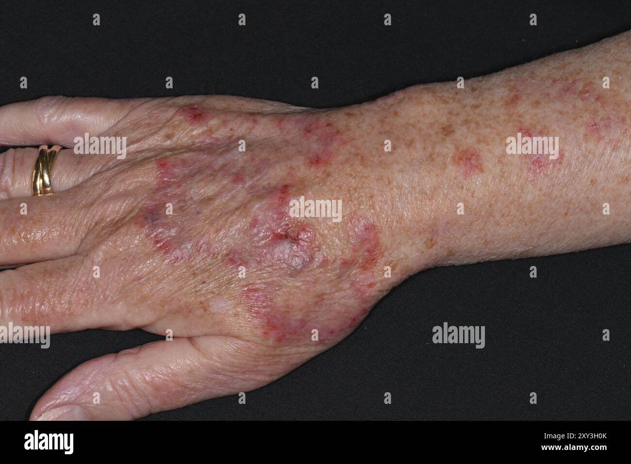 Drug rash on the hand of a 70 year old female patient. This is the body ...