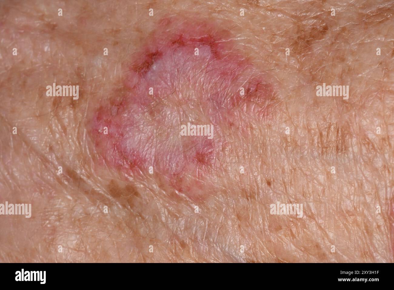 Drug rash on the hand of a 70 year old female patient. This is the body ...