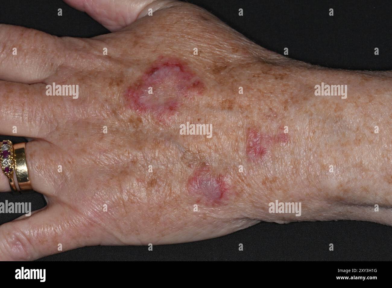 Drug rash on the hand of a 70 year old female patient. This is the body ...