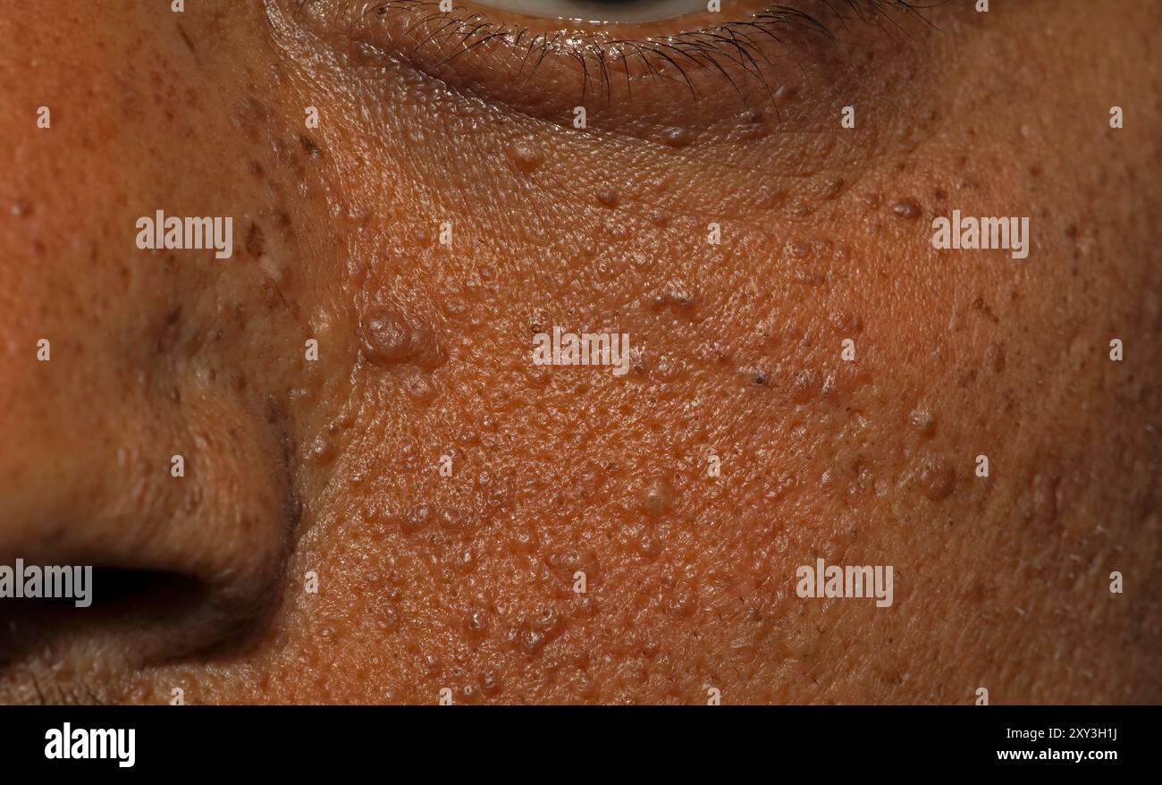 Cheek of a male patient with skin lesions (cutaneous angiofibromas ...