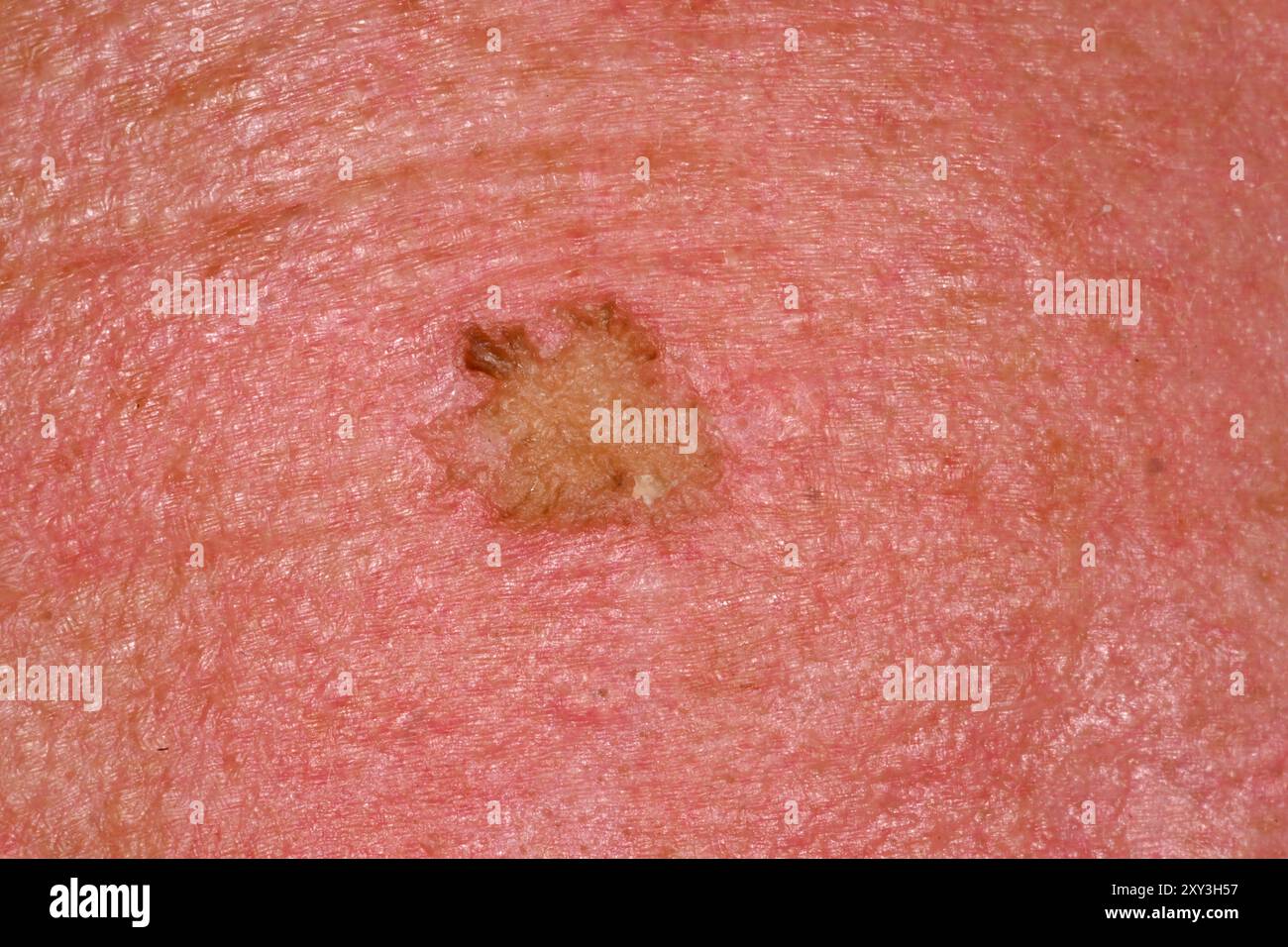 Solar keratosis on the scalp of a 64 year old male patient Stock Photo ...