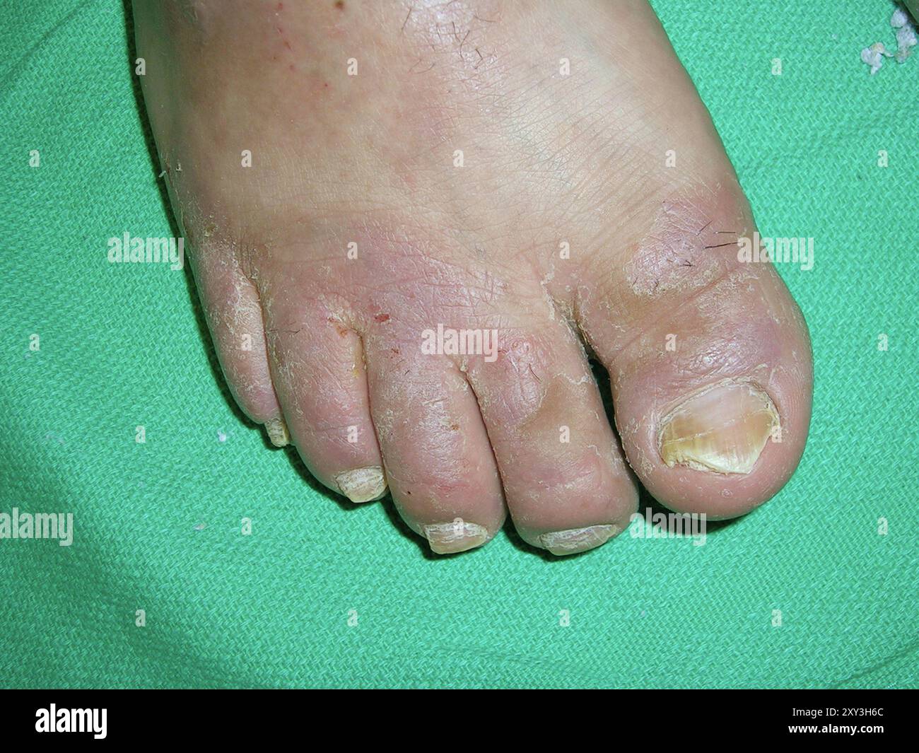 Athlete's foot infection. Athlete's foot, or tinea pedis, is a form of ...