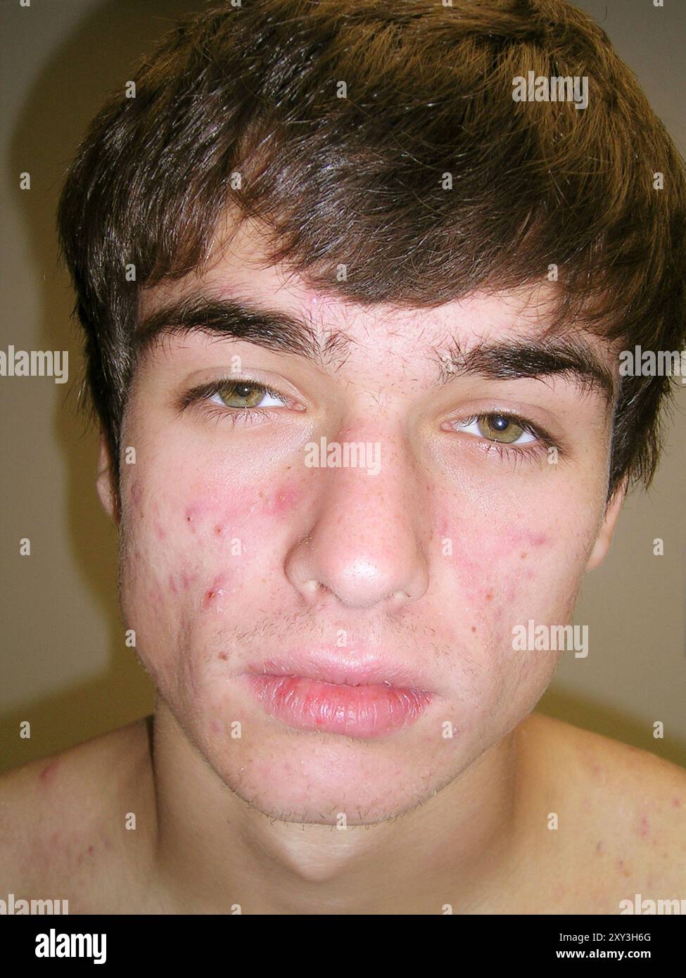 Editorial use only Face of a 16 year old male patient whose acne has ...