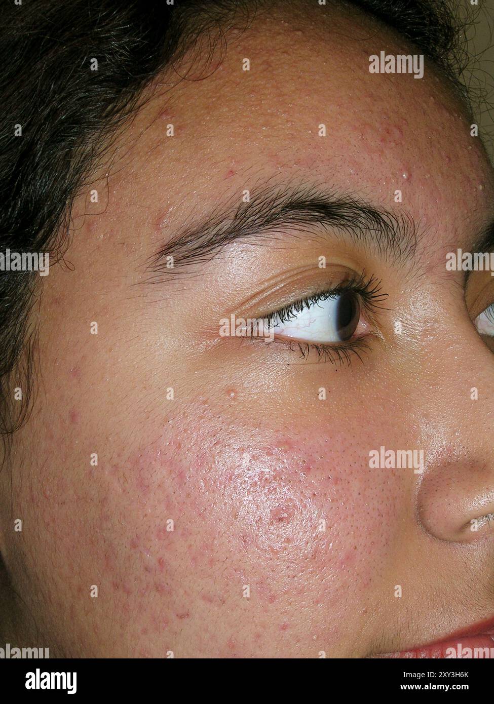 Acne on a patient's face. Acne is a general name given to a skin ...