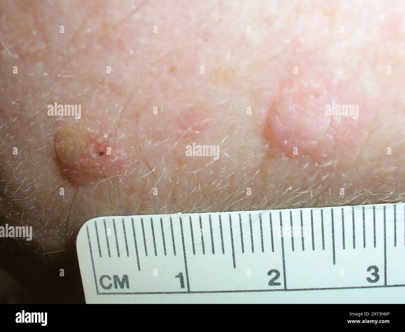 Seborrheic keratosis (left) on a patient's skin. This skin growth, also ...
