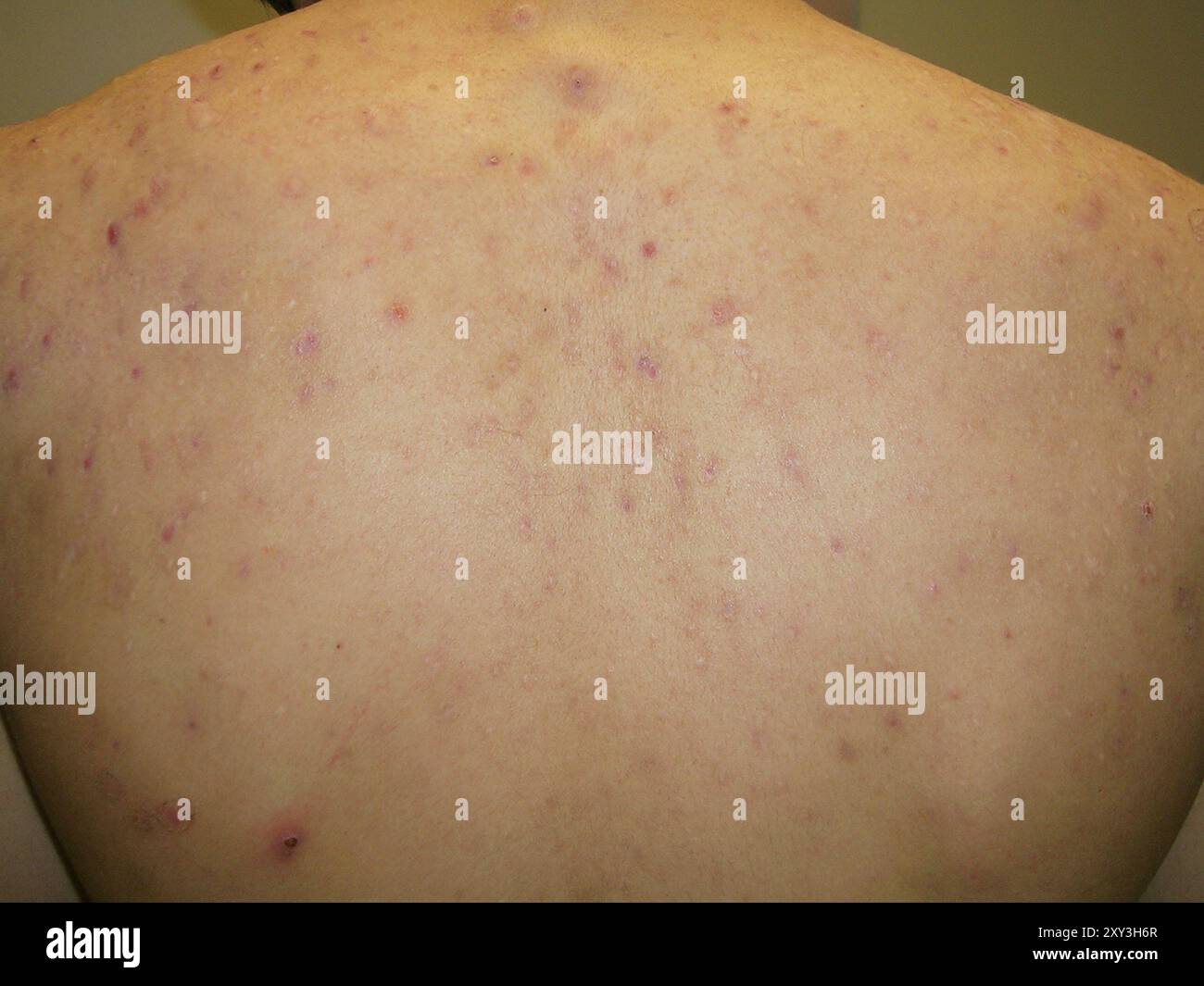 Back of a 16 year old male patient whose acne has been taking the ...