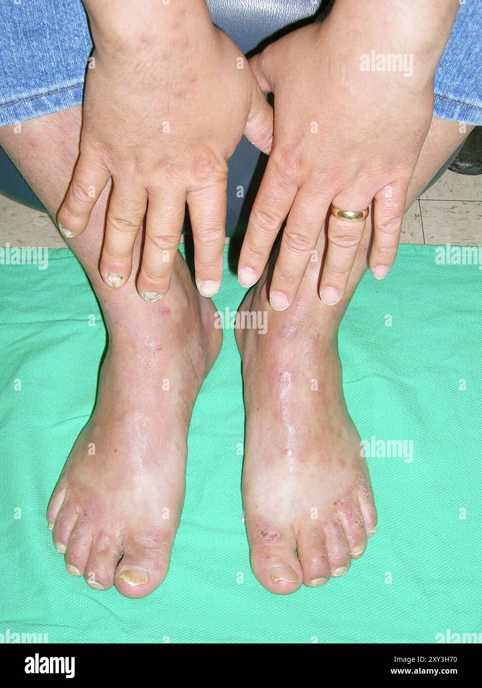 Ringworm infection on both of a patient's feet and one hand. Ringworm ...