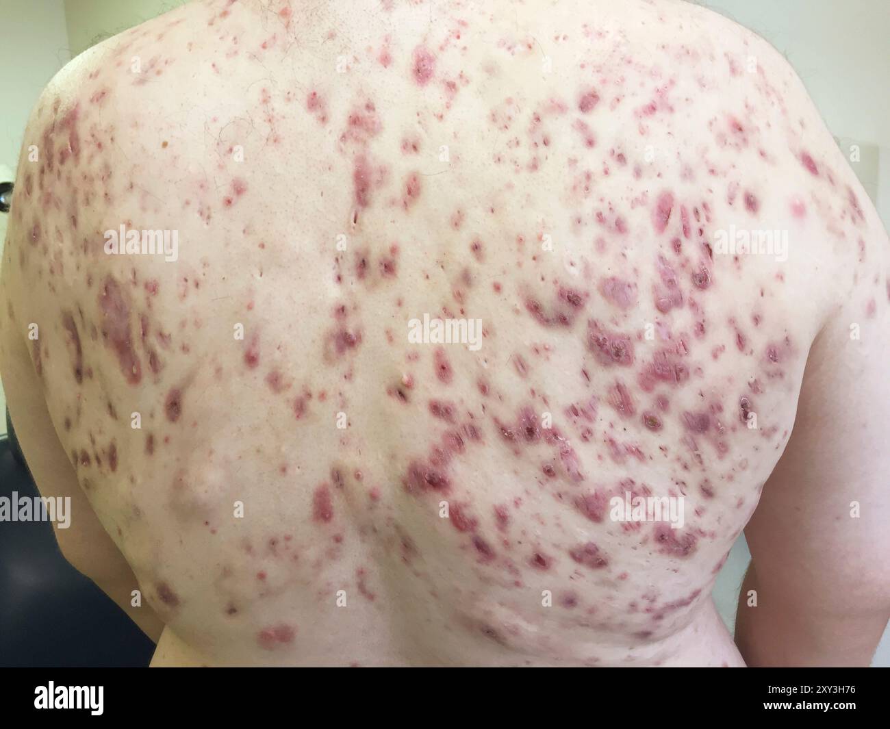 Acne conglobata on a patient's back. Acne conglobata is a highly ...