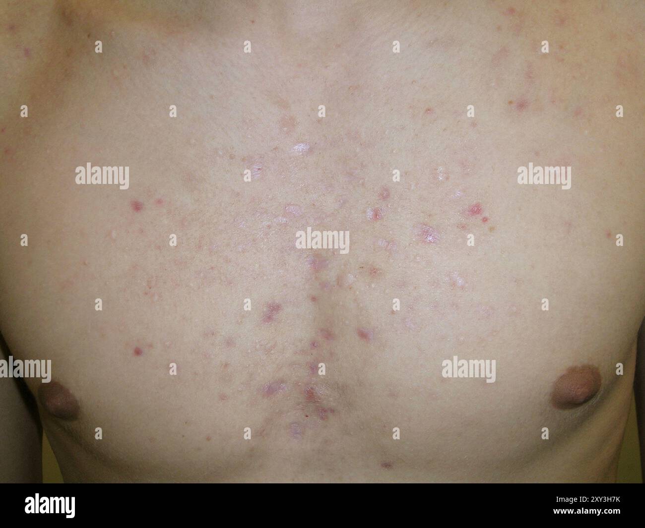 Chest of a 16 year old male patient whose acne has been taking the ...