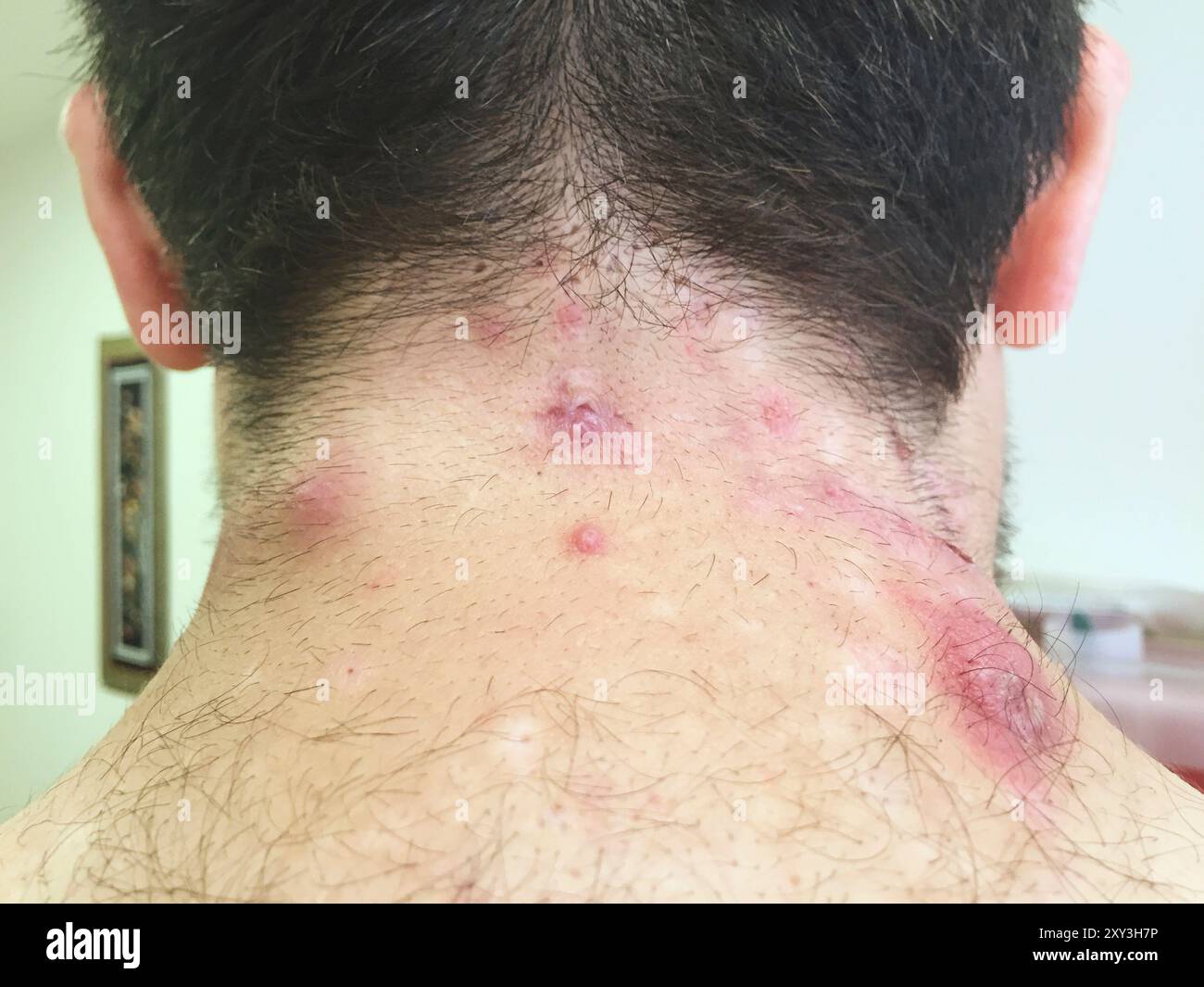 Acne conglobata on a patient's neck. Acne conglobata is a highly ...