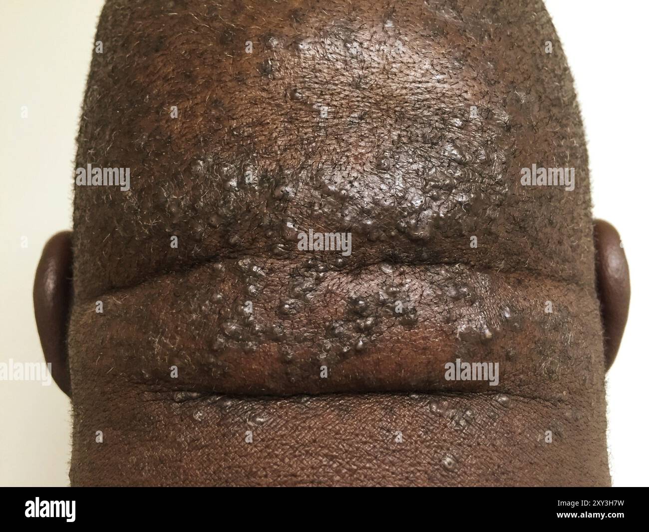 Acne keloidalis nuchae (AKN) in a 57 year old African American male ...