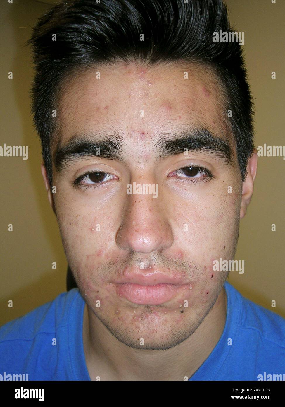 Face of a male patient whose acne is returning after he stopped taking ...