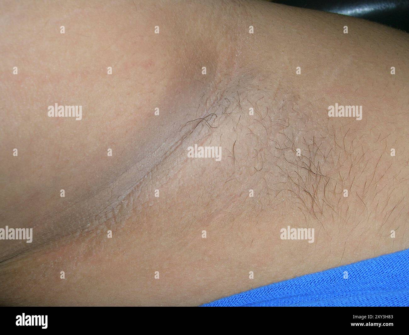 Darkened skin in the armpit of an obese 12 year old Hispanic girl in a ...