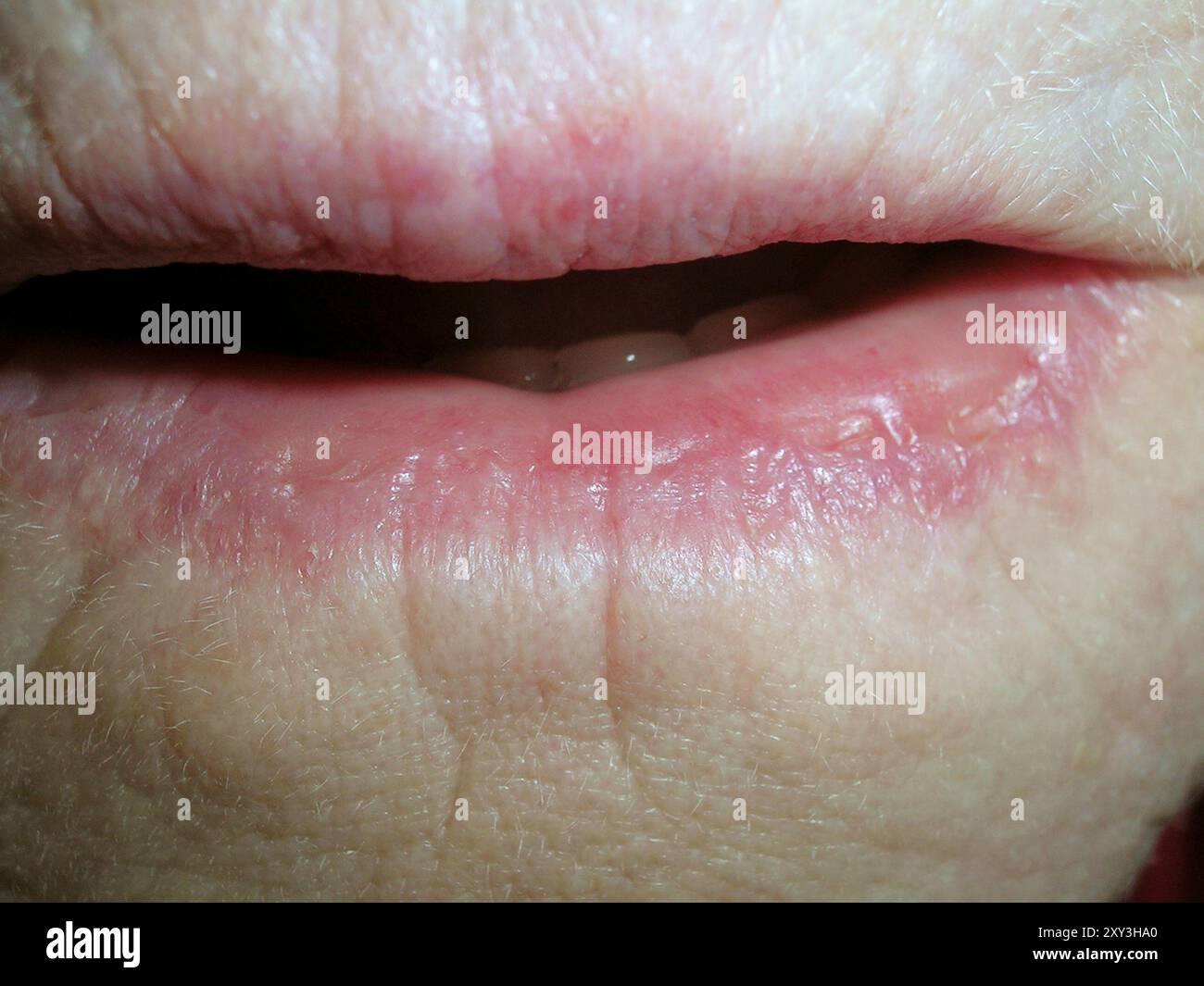 Actinic cheilitis lesions on a patient's lip after treatment with ...