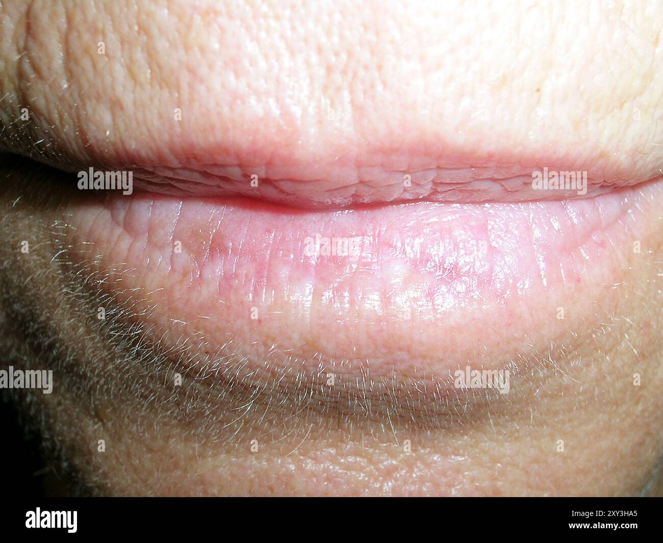 Actinic cheilitis lesions on a patient's lip after treatment with ...